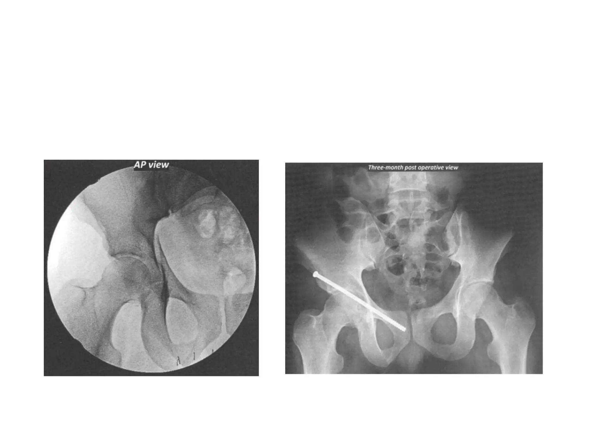 Acetabulum Fracture | PPTX