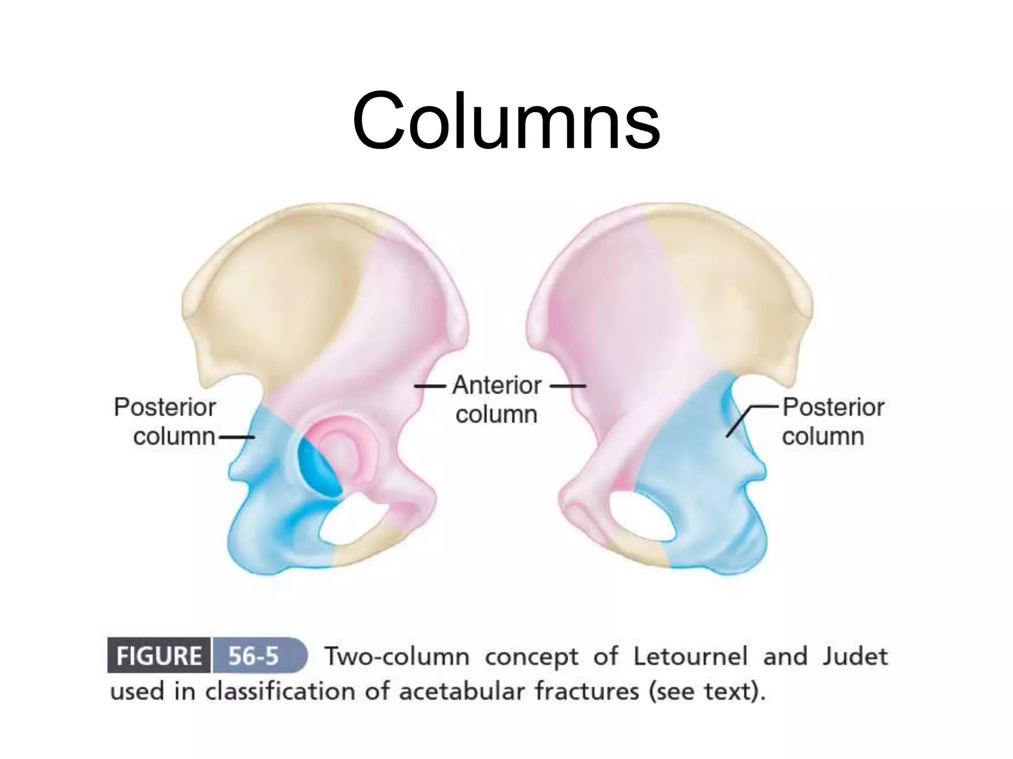 Acetabulum Fracture | PPTX