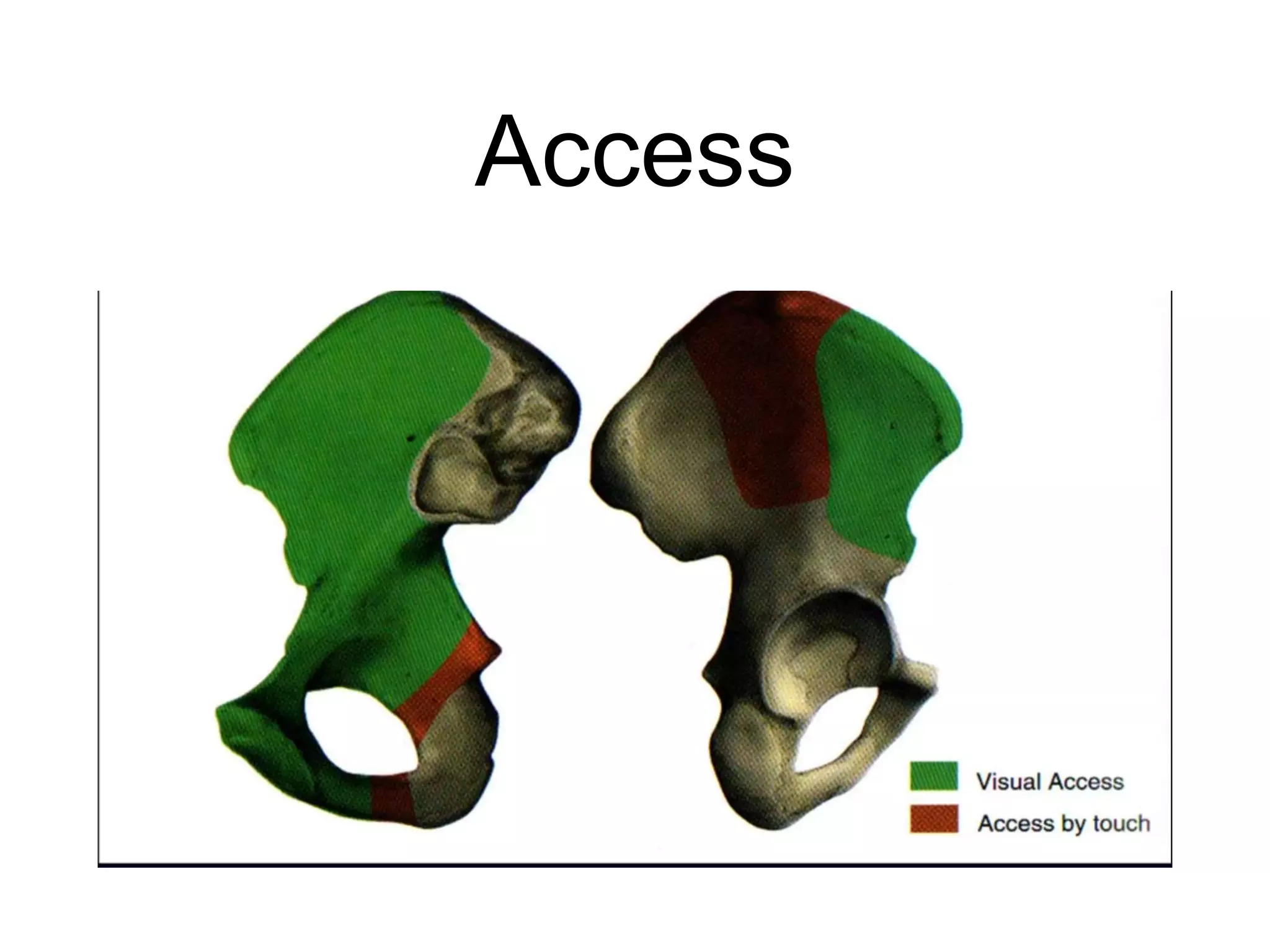 Acetabulum Fracture | PPTX