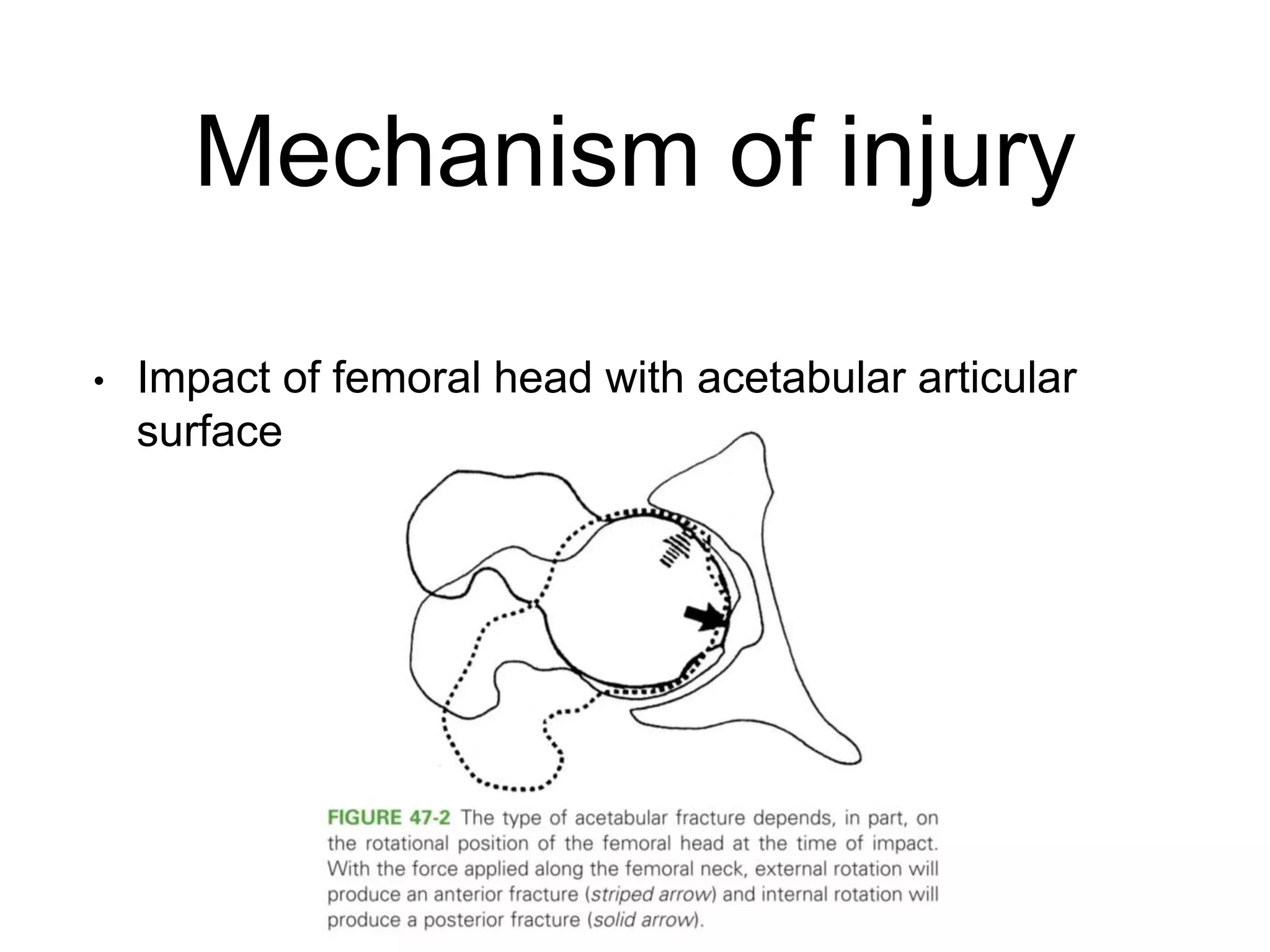 Acetabulum Fracture | PPTX