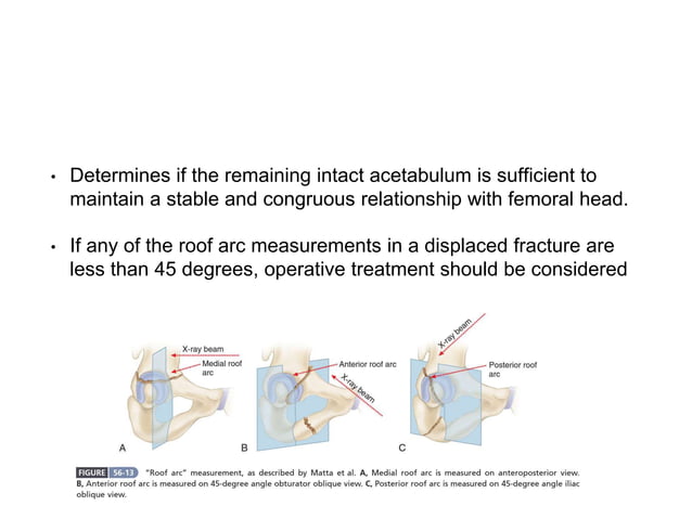 Acetabulum Fracture | PPT