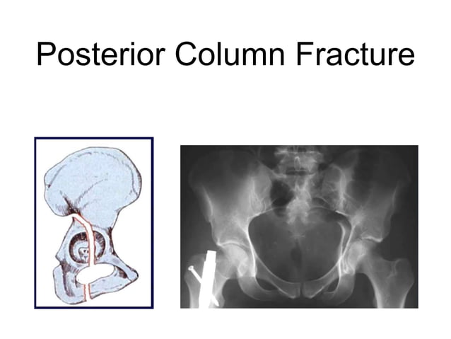 Acetabulum Fracture | PPT