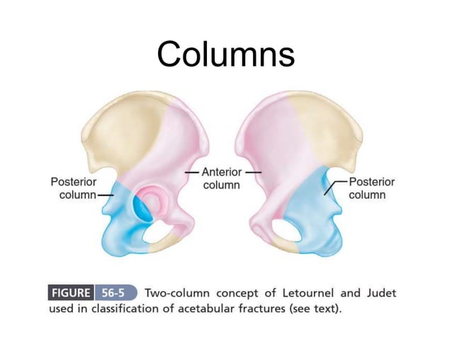 Acetabulum Fracture | PPT