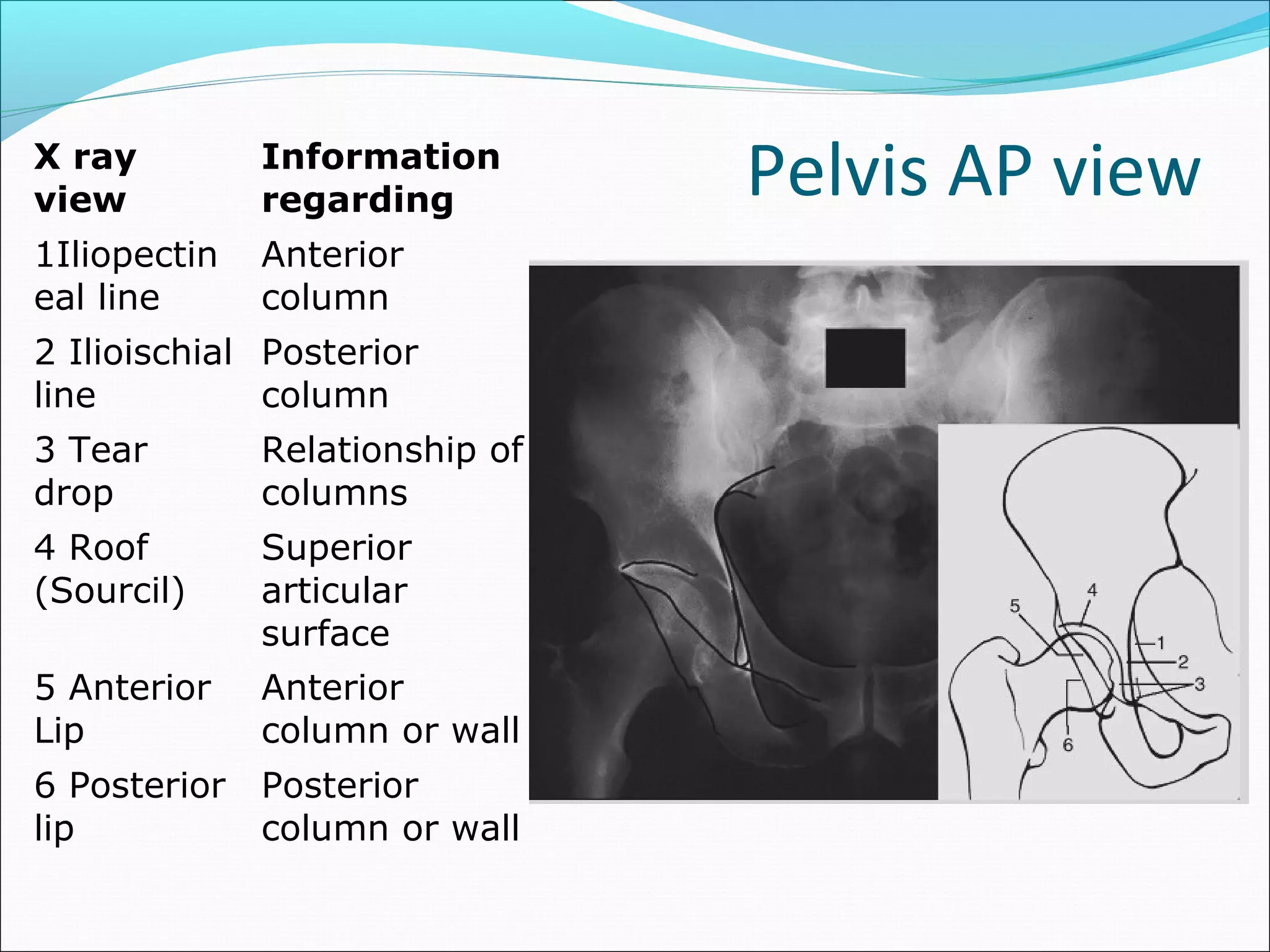 Acetabulum fractures | PPT