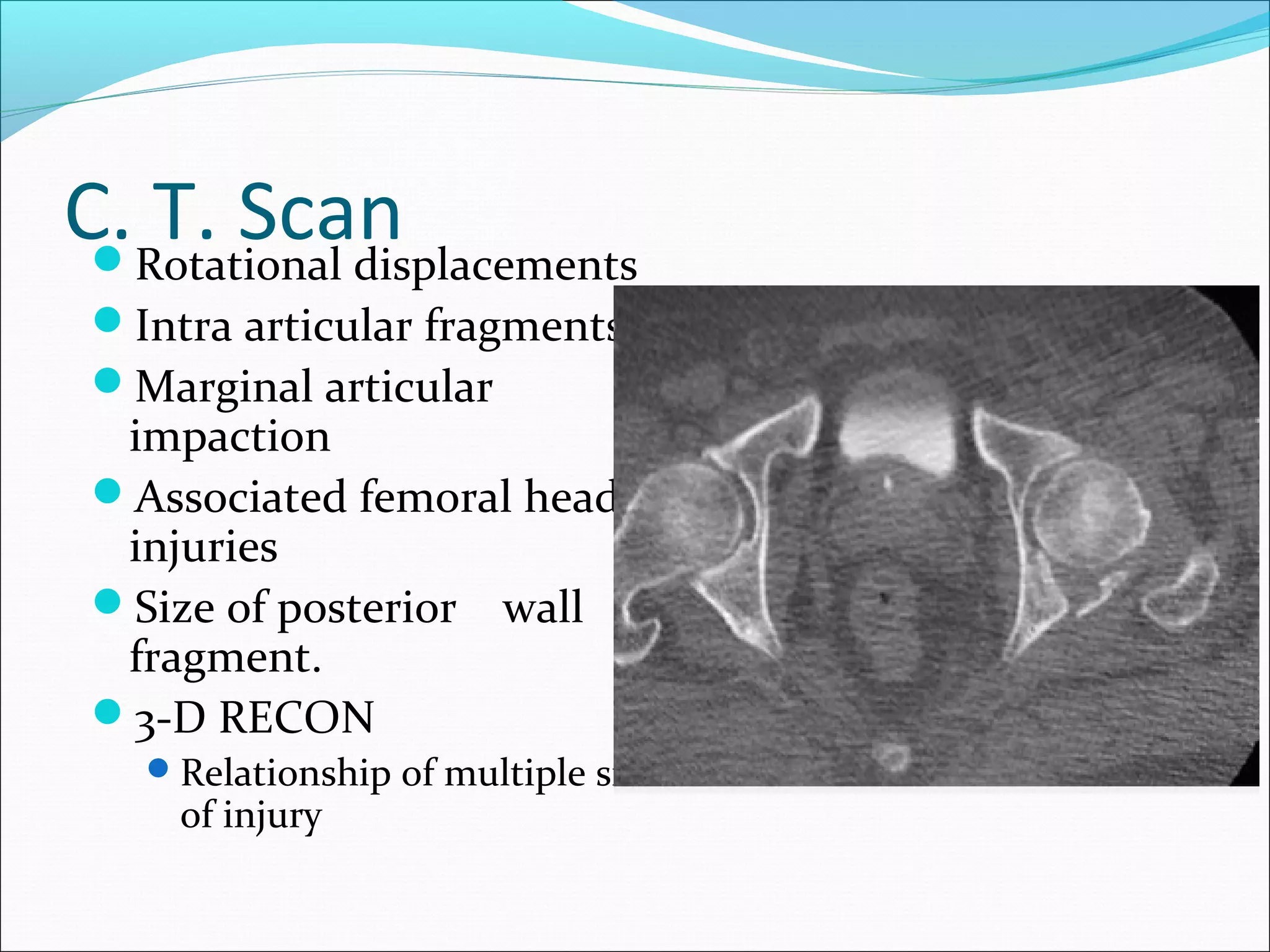 Acetabulum fractures | PPT