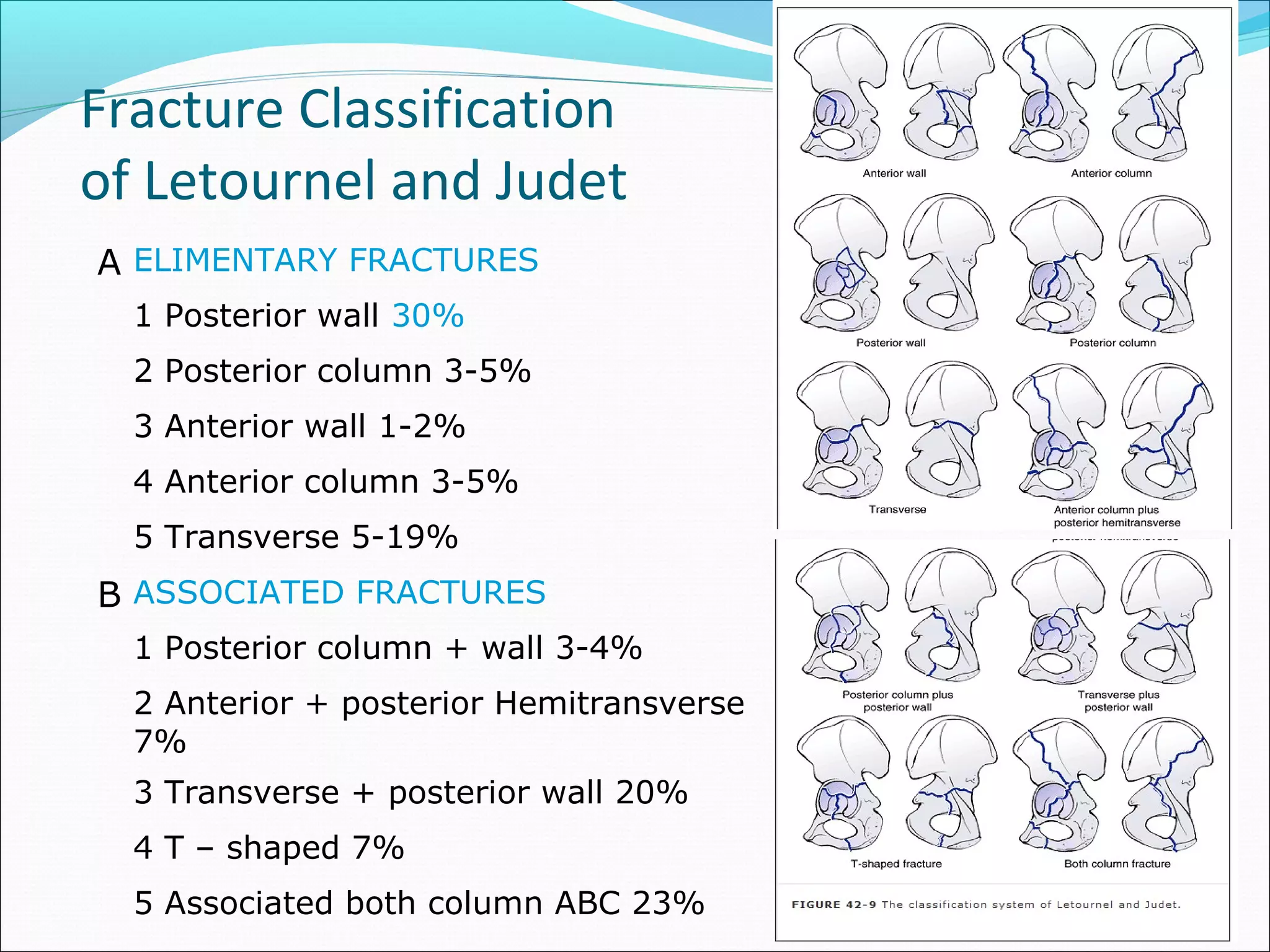 Acetabulum fractures | PPT