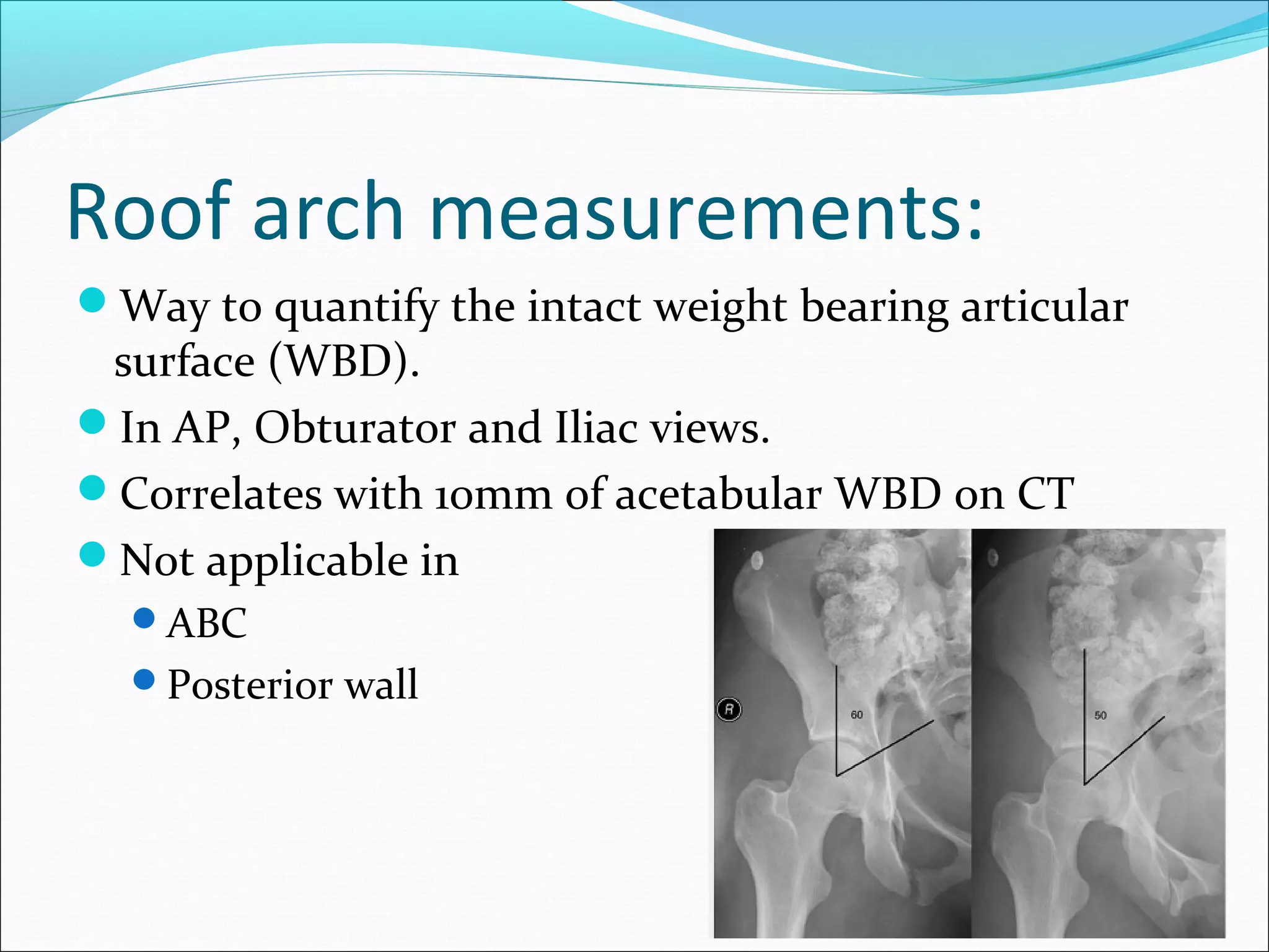 Acetabulum fractures | PPT