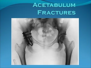 Acetabulum fractures | PPT