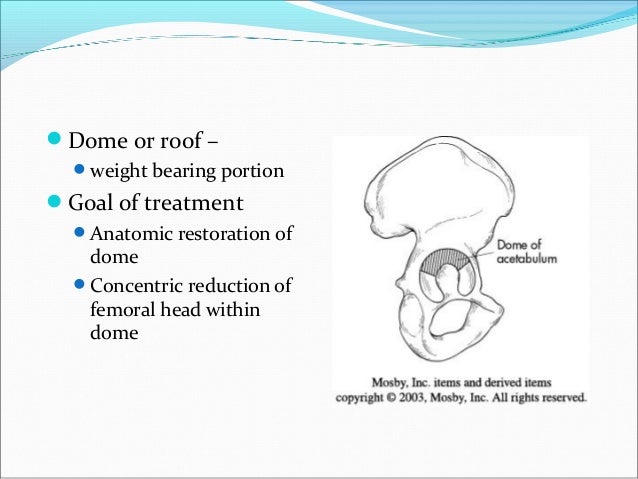 Acetabulum fractures