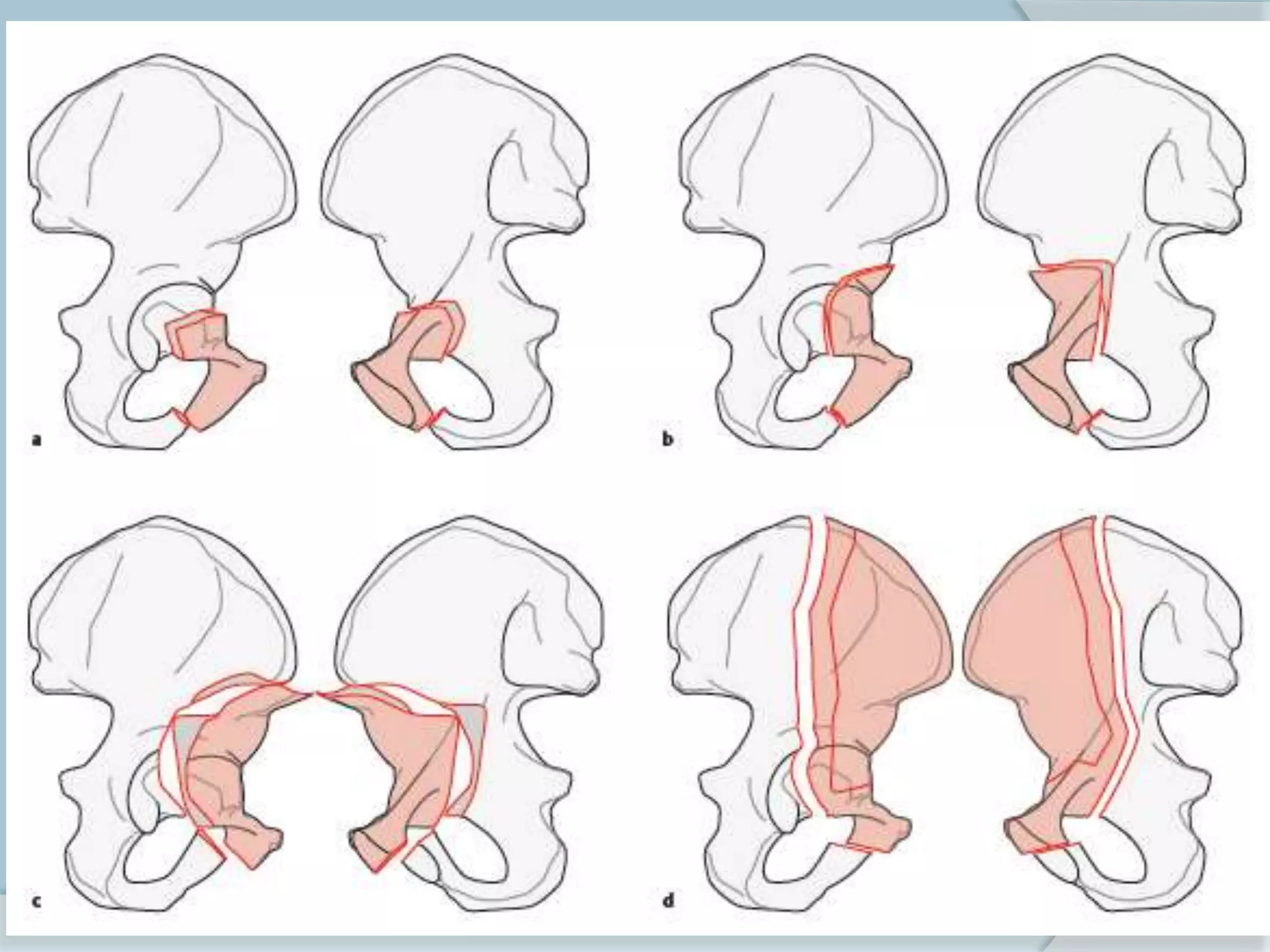 Acetabulum fractures | PPTX