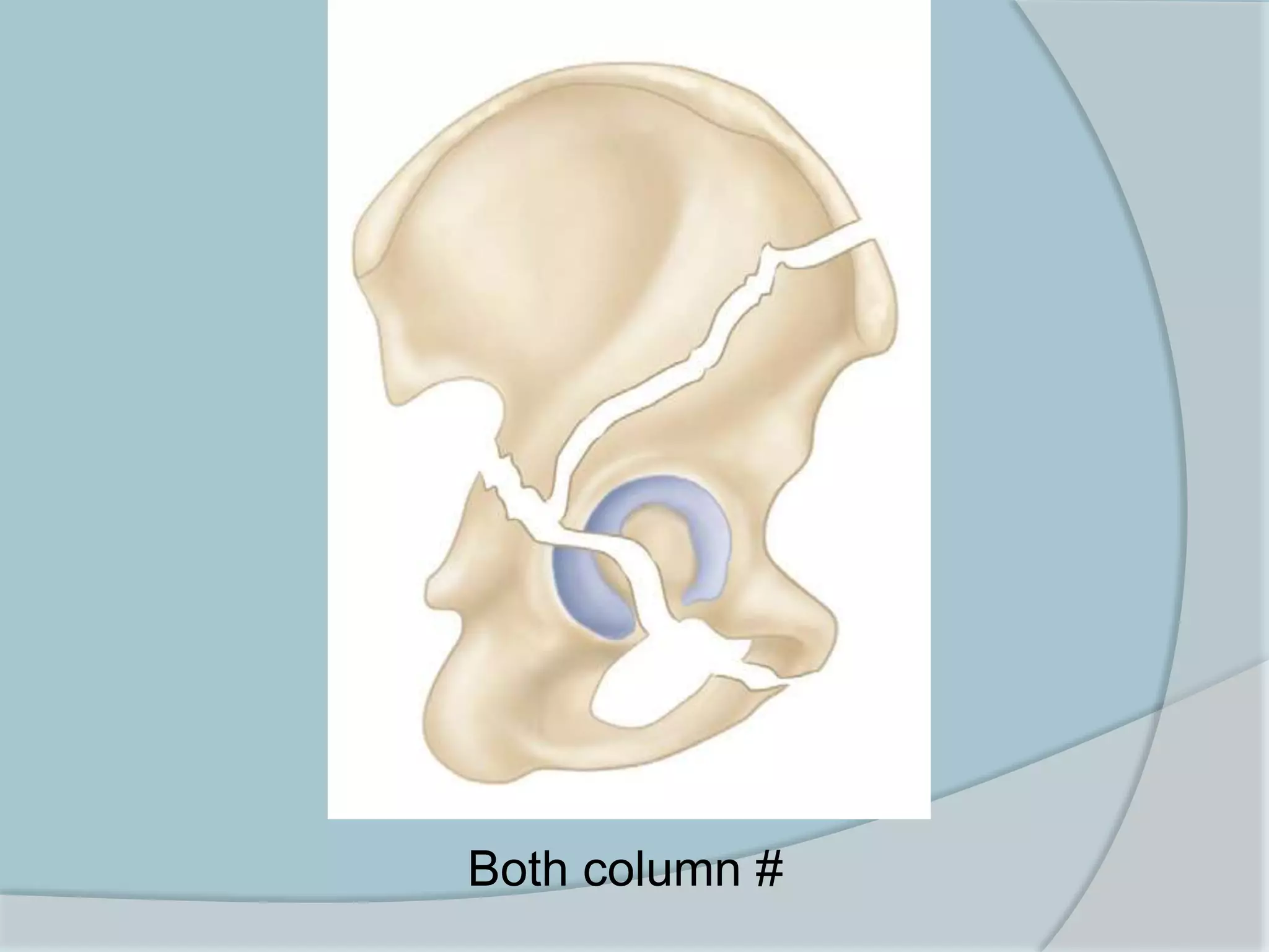 Acetabulum fractures | PPTX