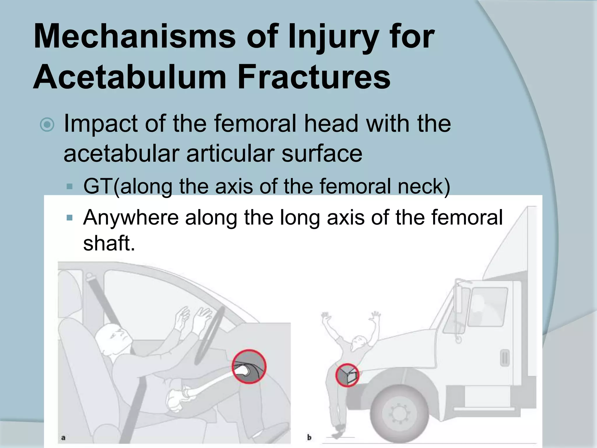 Acetabulum fractures | PPTX
