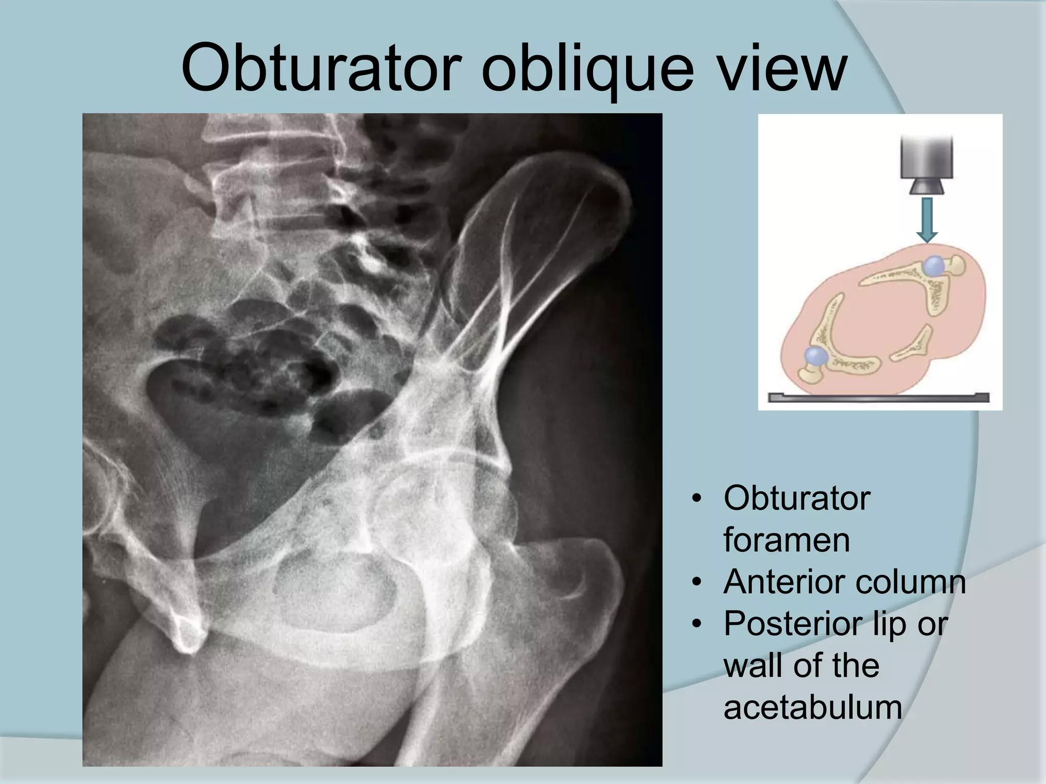 Acetabulum fractures | PPTX