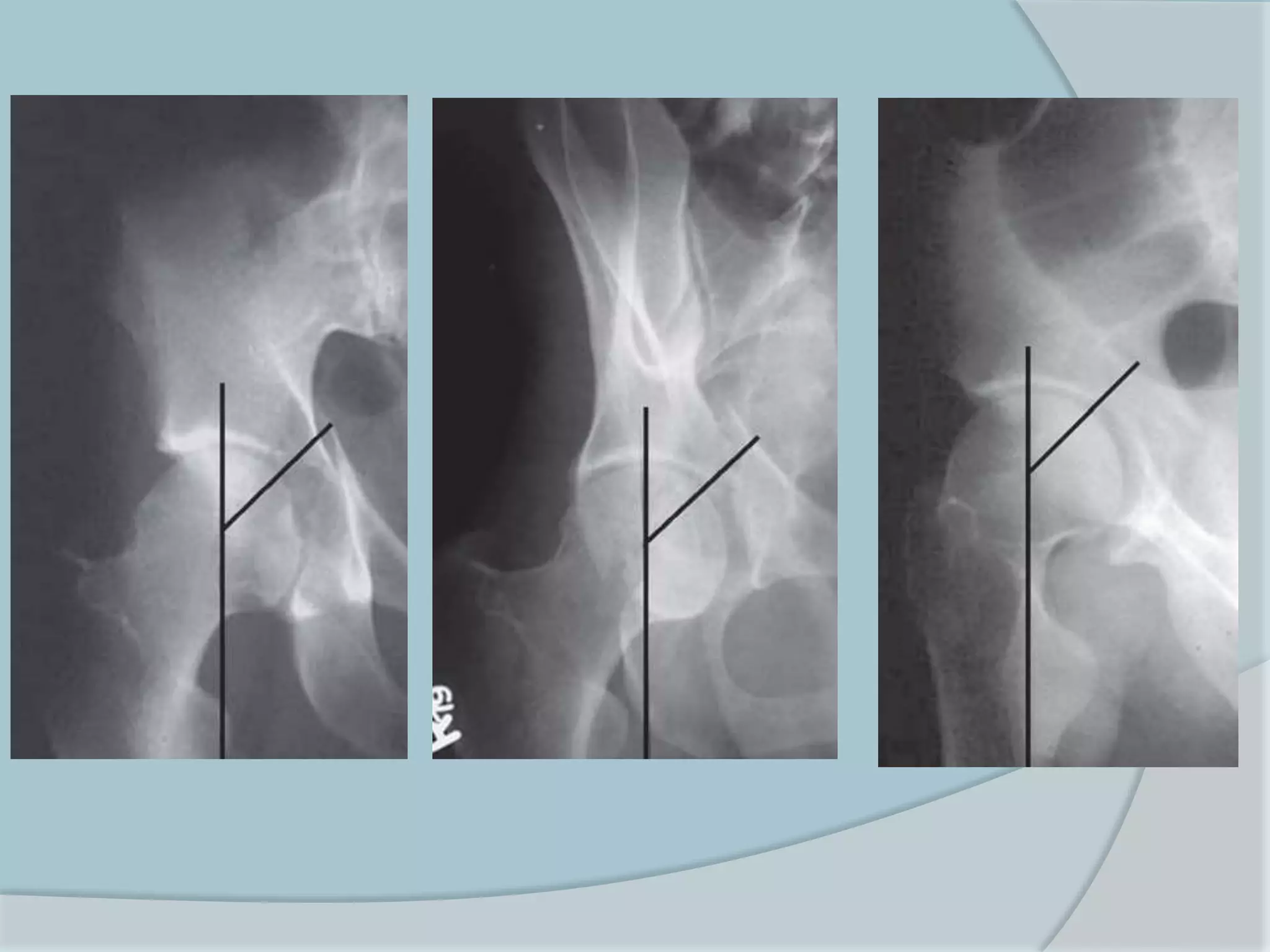 Acetabulum fractures | PPTX
