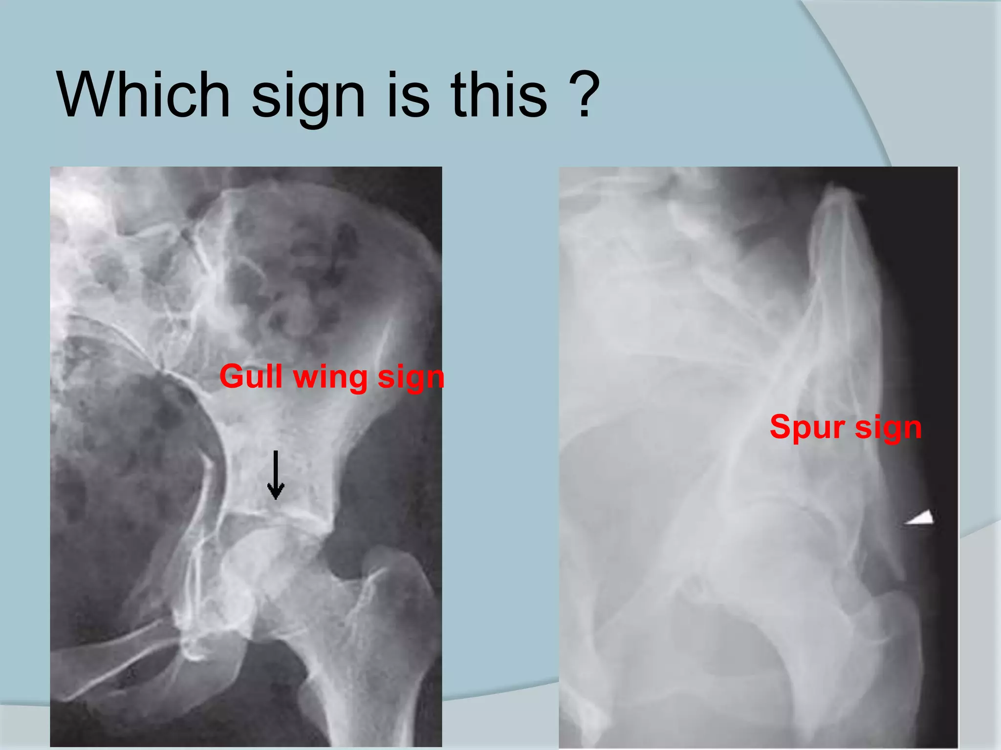 Acetabulum fractures | PPTX