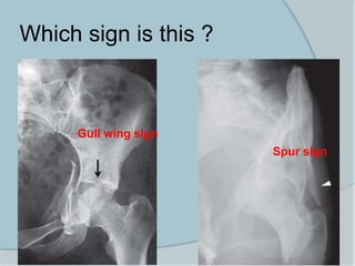 Acetabulum fractures | PPTX