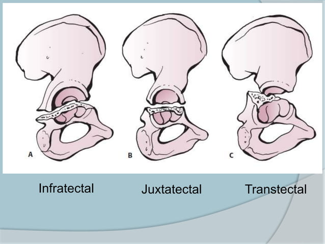 Acetabulum fractures | PPT