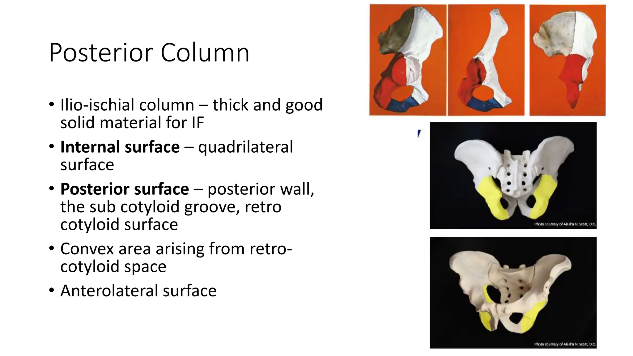 Acetabulum Fractures - Anatomy, Radiological Evaluation, Classification ...