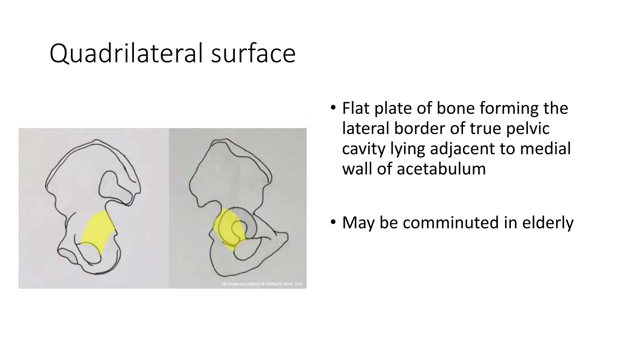 Acetabulum Fractures - Anatomy, Radiological Evaluation, Classification ...