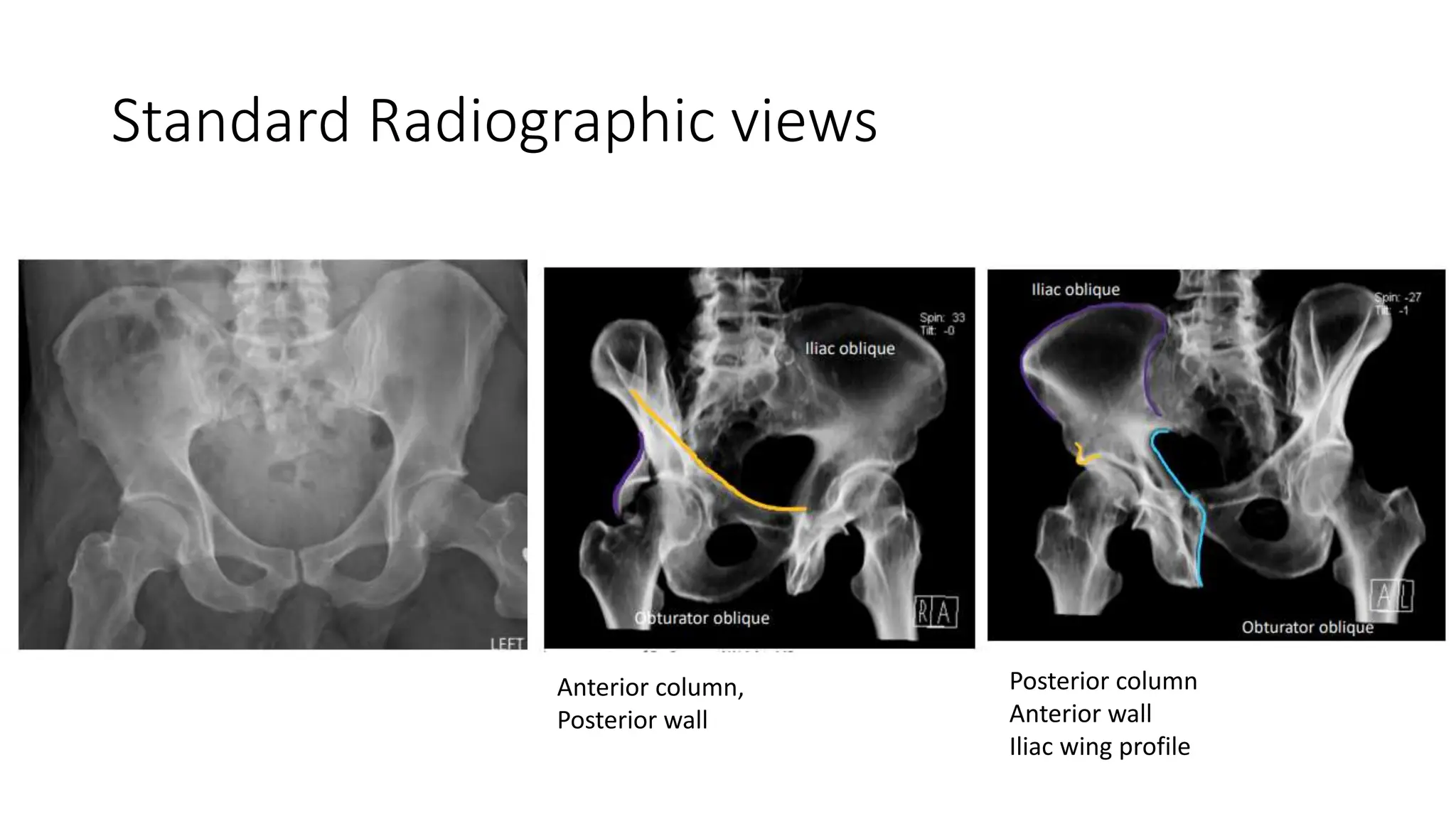 Acetabulum Fractures - Anatomy, Radiological Evaluation, Classification ...
