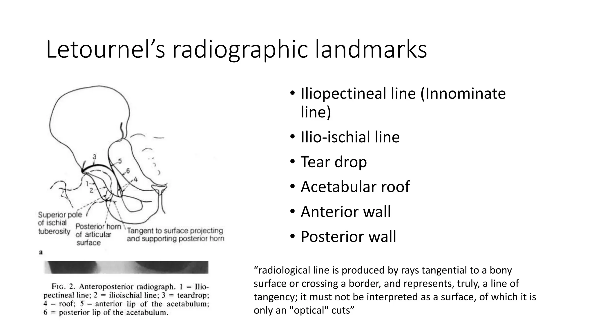 Acetabulum Fractures - Anatomy, Radiological Evaluation, Classification ...