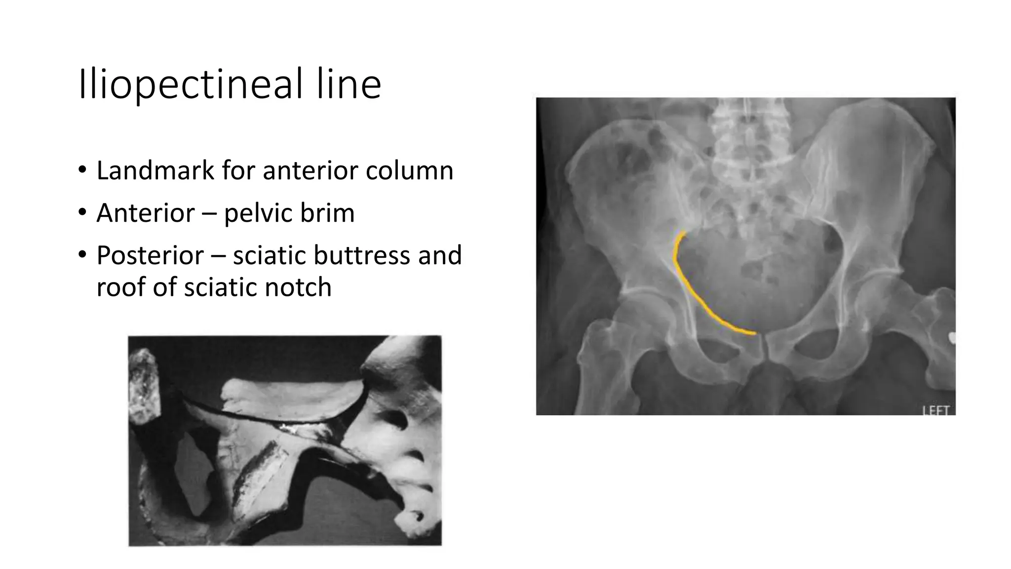 Acetabulum Fractures - Anatomy, Radiological Evaluation, Classification ...