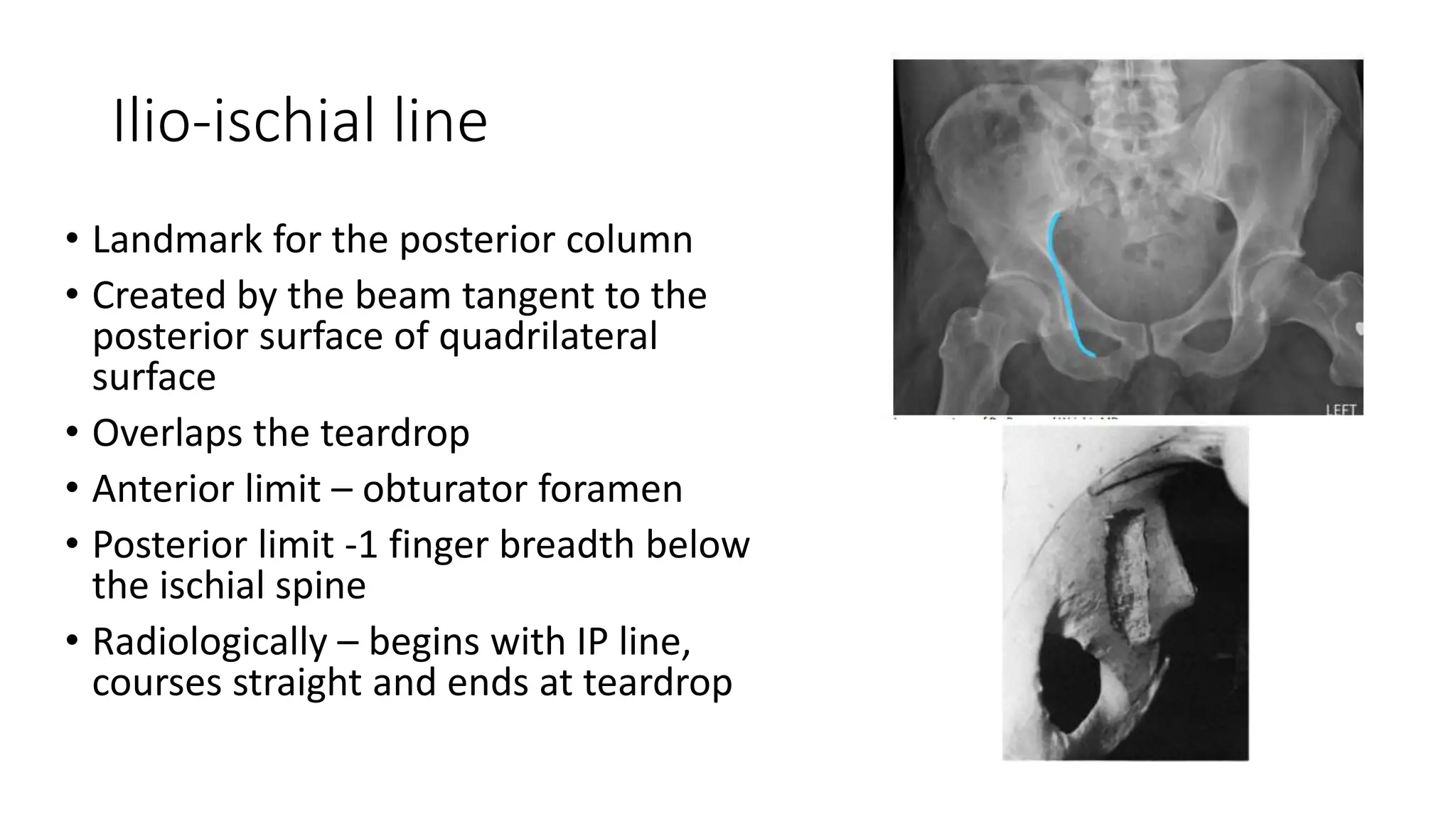 Acetabulum Fractures - Anatomy, Radiological Evaluation, Classification ...