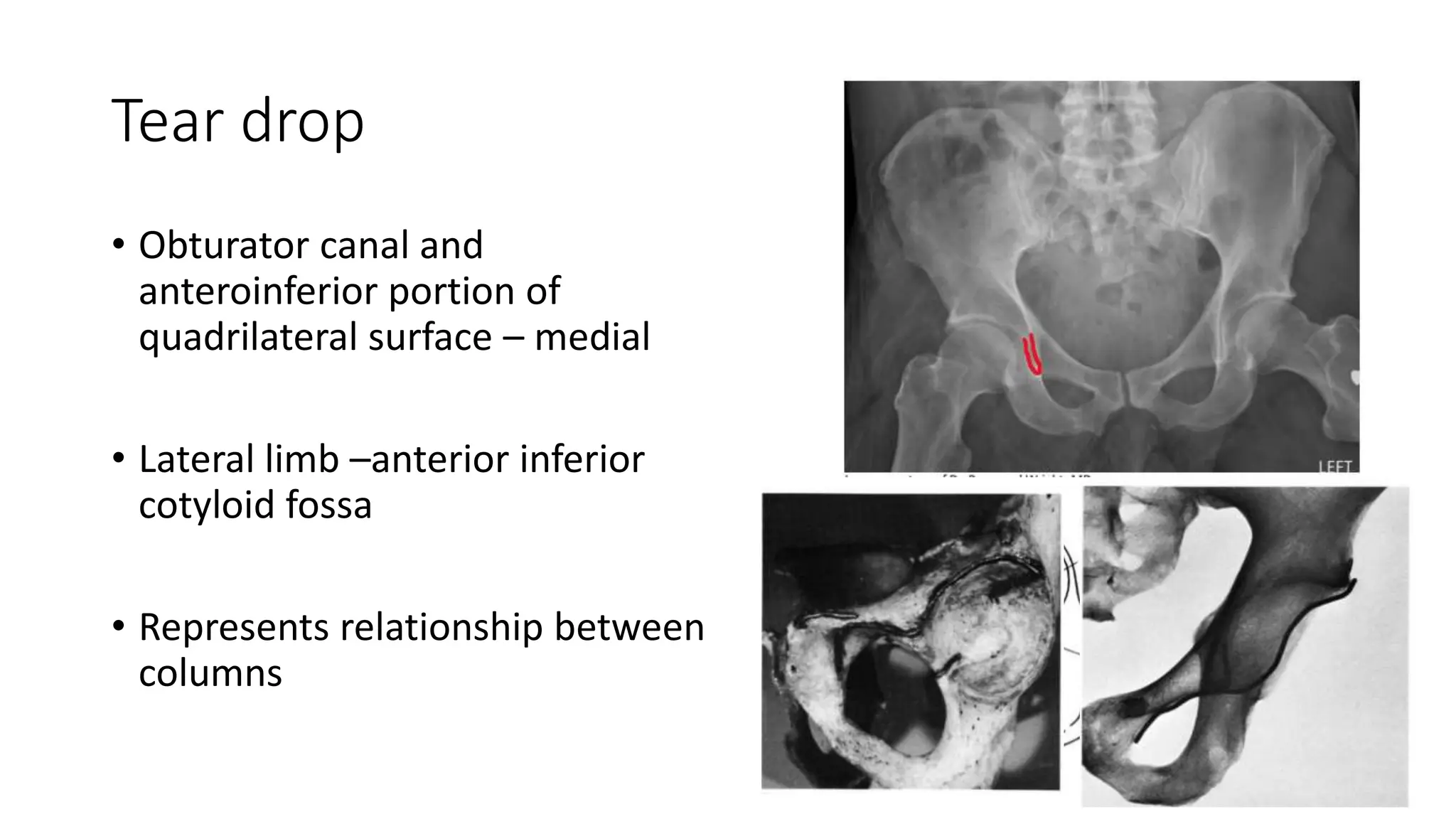 Acetabulum Fractures - Anatomy, Radiological Evaluation, Classification ...