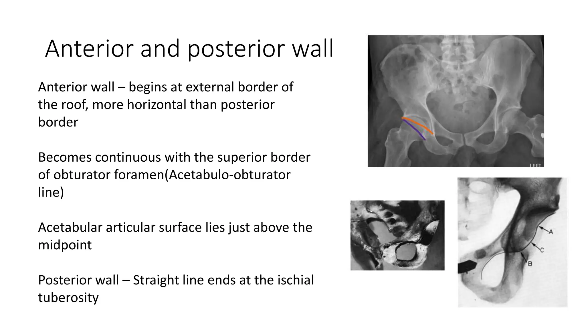 Acetabulum Fractures - Anatomy, Radiological Evaluation, Classification ...