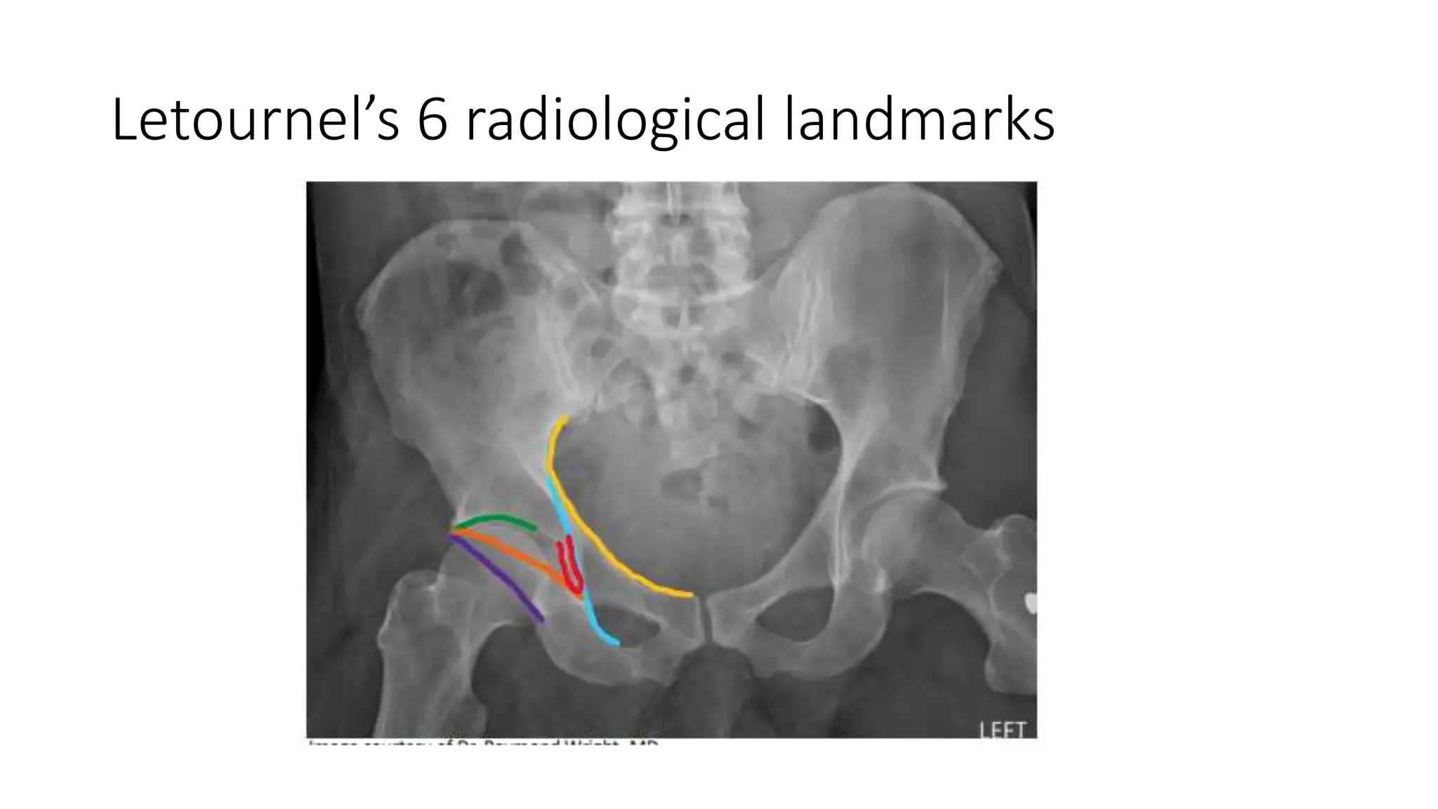 Acetabulum Fractures - Anatomy, Radiological Evaluation, Classification ...