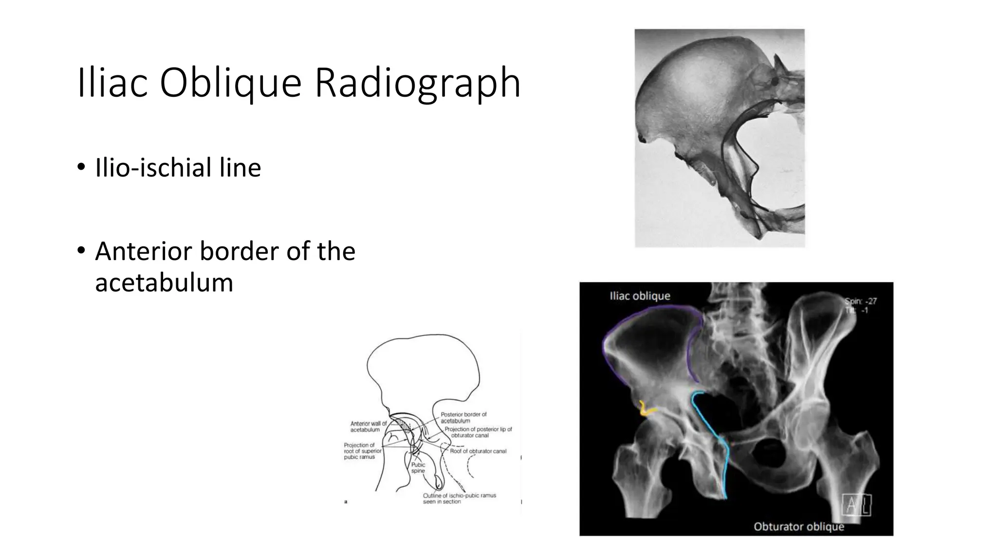 Acetabulum Fractures - Anatomy, Radiological Evaluation, Classification ...