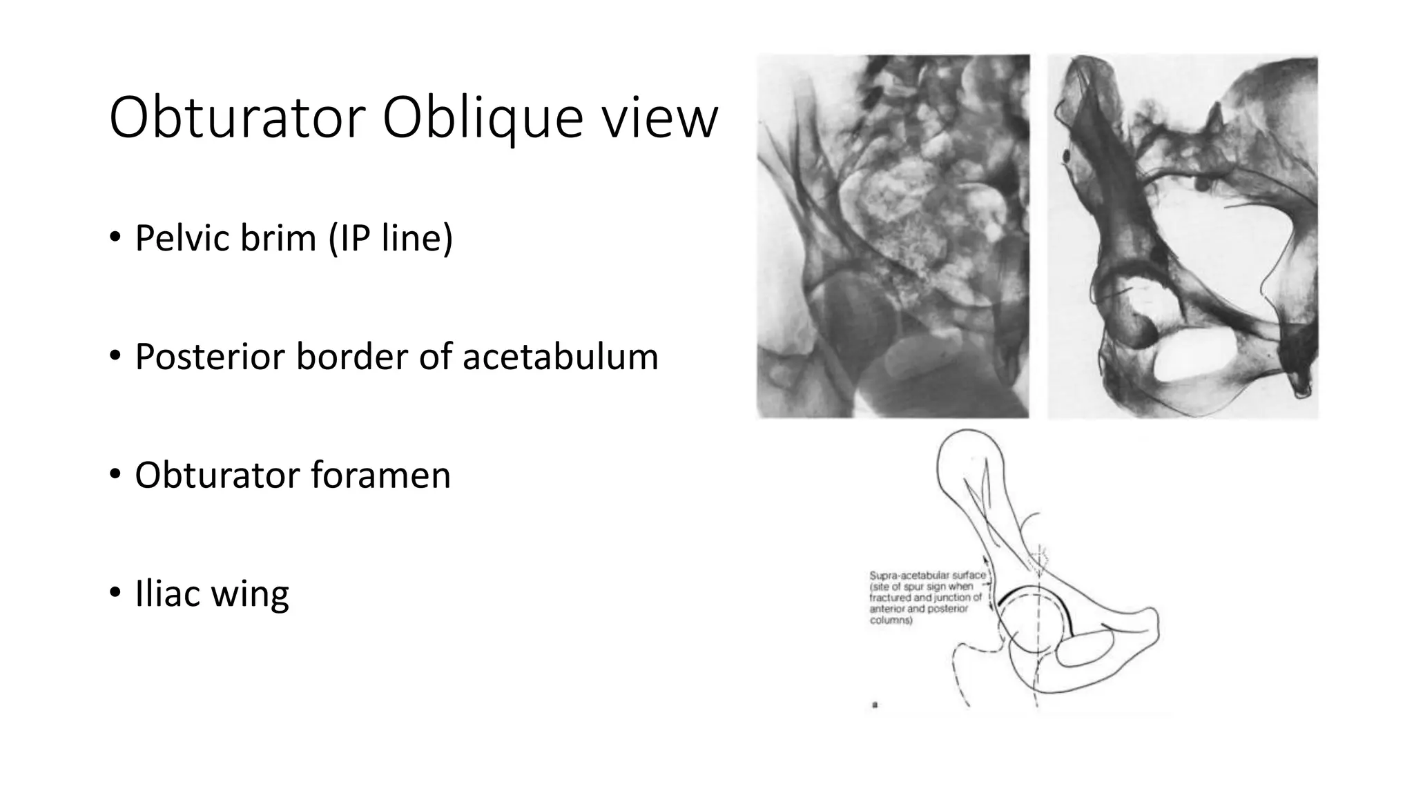 Acetabulum Fractures - Anatomy, Radiological Evaluation, Classification ...