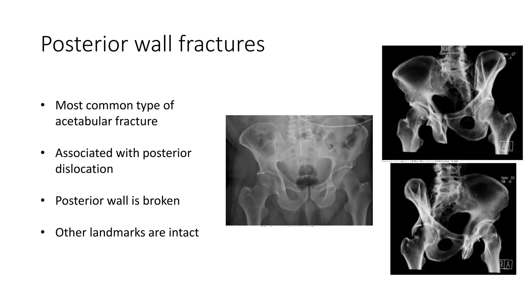 Acetabulum Fractures Anatomy Radiological Evaluation Classification And Management Ppt