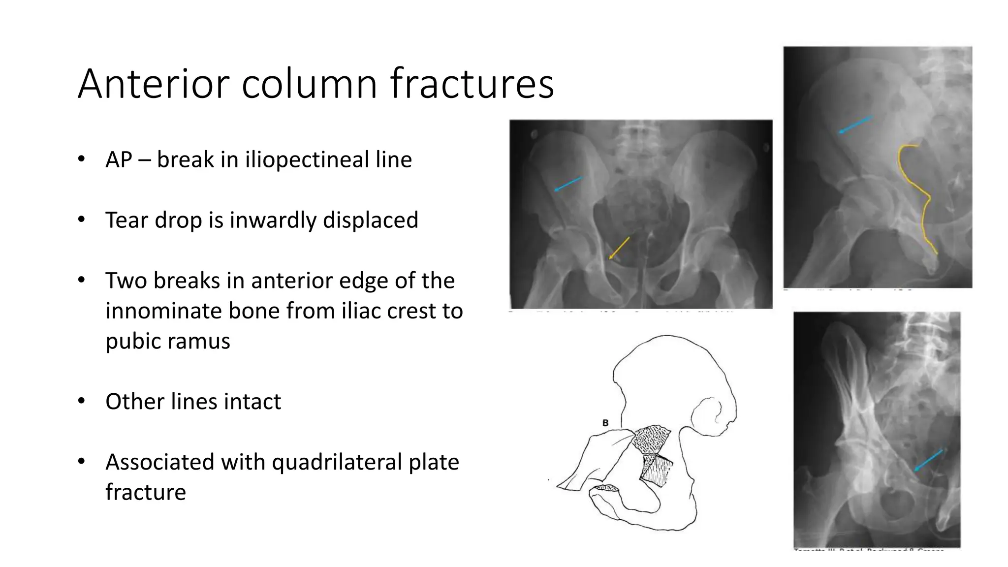 Acetabulum Fractures - Anatomy, Radiological Evaluation, Classification ...