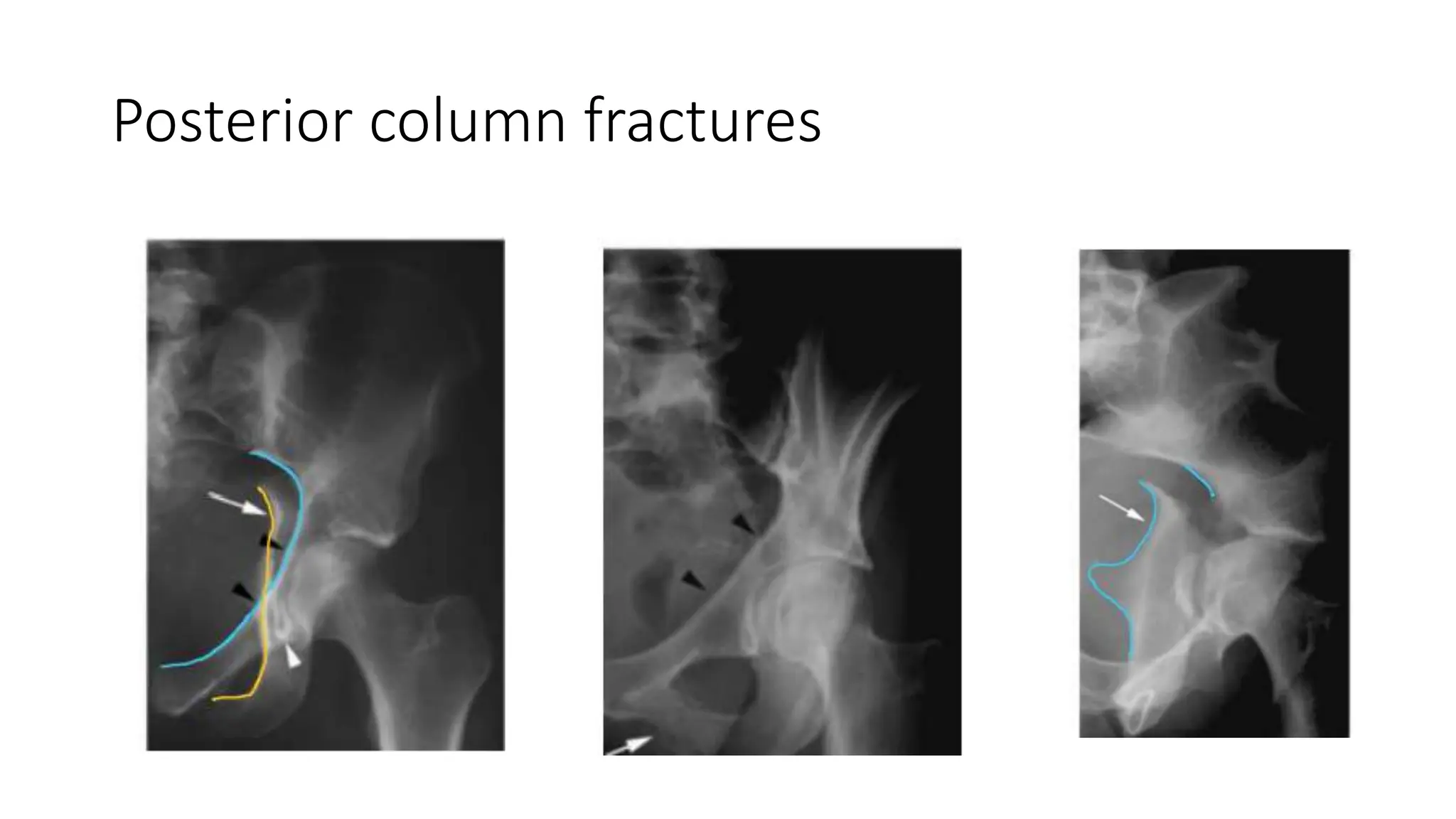 Acetabulum Fractures - Anatomy, Radiological Evaluation, Classification ...