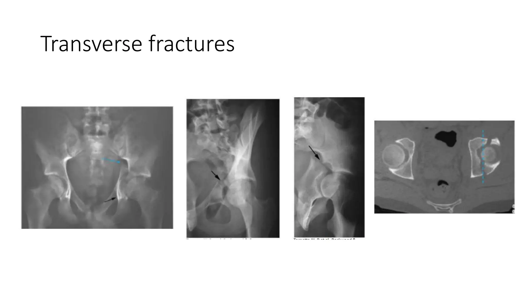 Acetabulum Fractures - Anatomy, Radiological Evaluation, Classification ...