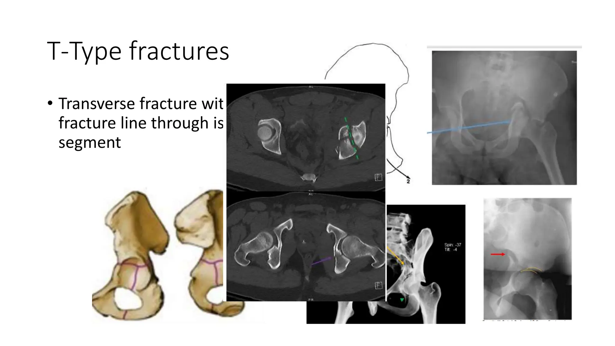 Acetabulum Fractures - Anatomy, Radiological Evaluation, Classification ...