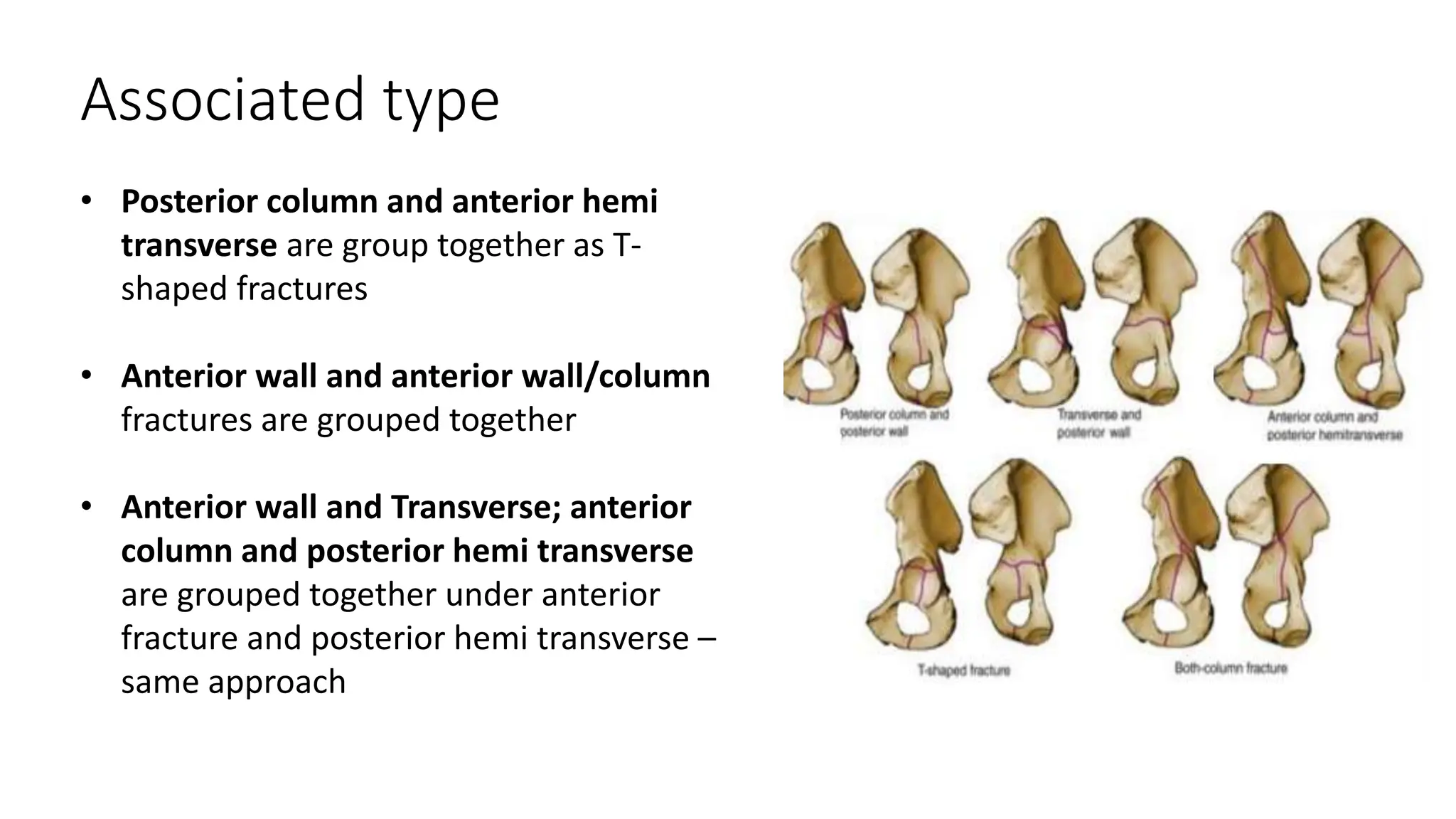 Acetabulum Fractures - Anatomy, Radiological Evaluation, Classification ...