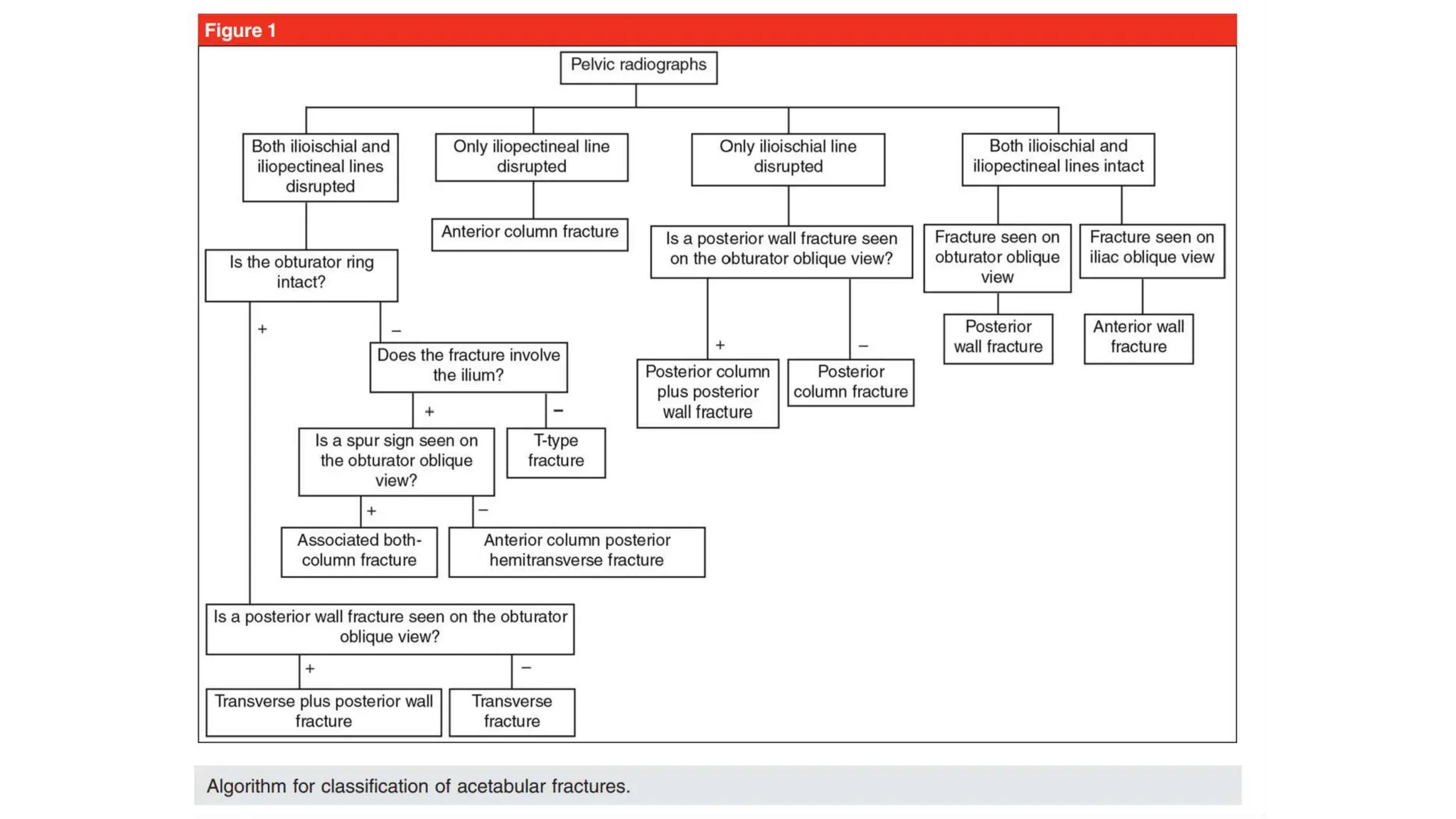 Acetabulum Fractures - Anatomy, Radiological Evaluation, Classification ...