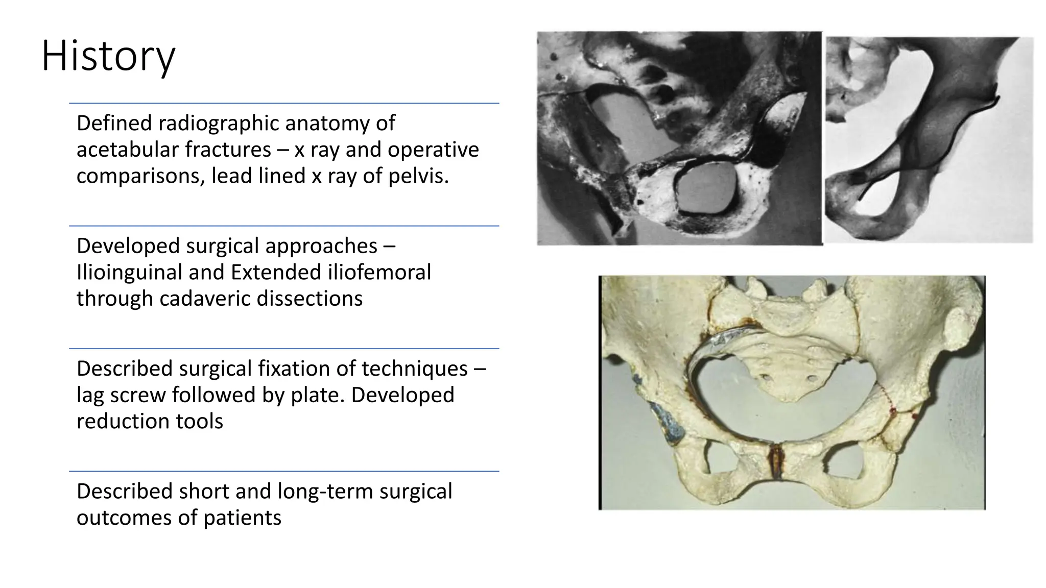 Acetabulum Fractures - Anatomy, Radiological Evaluation, Classification ...