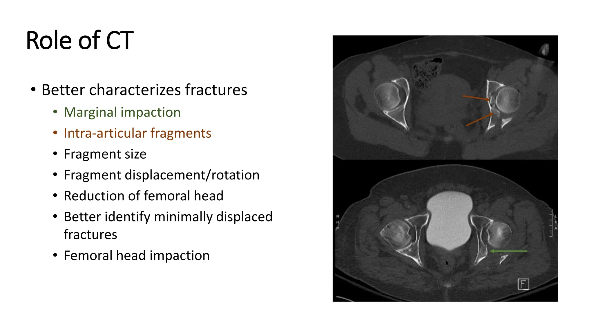 Acetabulum Fractures - Anatomy, Radiological Evaluation, Classification ...
