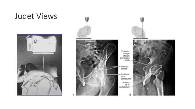 Acetabulum Fractures - Anatomy, Radiological Evaluation, Classification ...