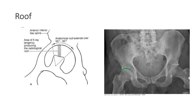 Acetabulum Fractures - Anatomy, Radiological Evaluation, Classification ...
