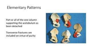 Acetabulum Fractures - Anatomy, Radiological Evaluation, Classification ...