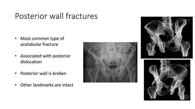 Acetabulum Fractures - Anatomy, Radiological Evaluation, Classification ...