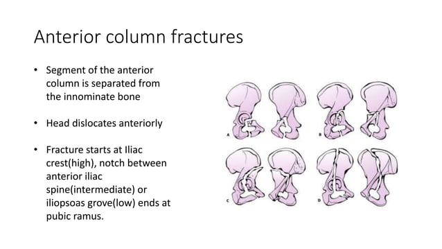 Acetabulum Fractures - Anatomy, Radiological Evaluation, Classification ...