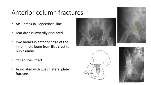 Acetabulum Fractures - Anatomy, Radiological Evaluation, Classification ...