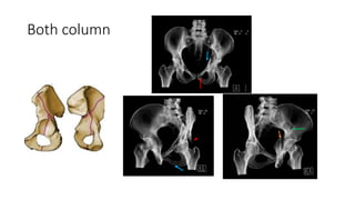 Acetabulum Fractures - Anatomy, Radiological Evaluation, Classification ...