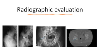 Acetabulum Fractures - Anatomy, Radiological Evaluation, Classification ...
