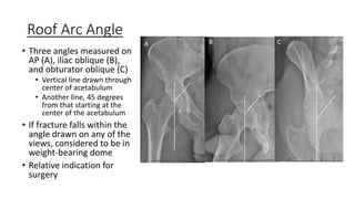 Acetabulum Fractures - Anatomy, Radiological Evaluation, Classification ...